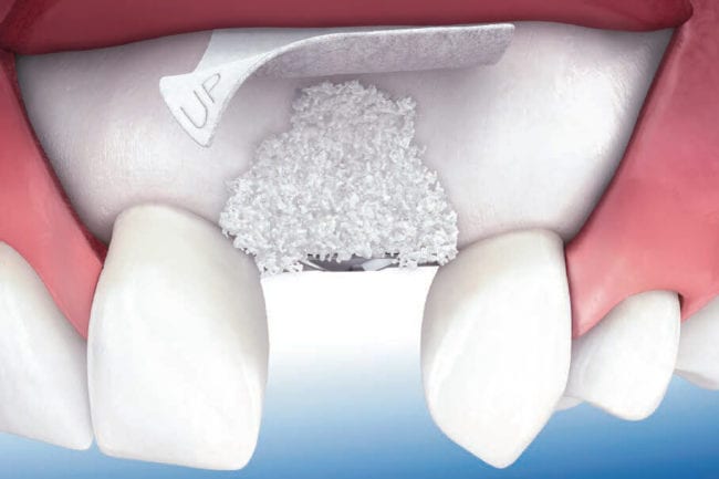 Discover if a bone graft is the right procedure for you | America Dental