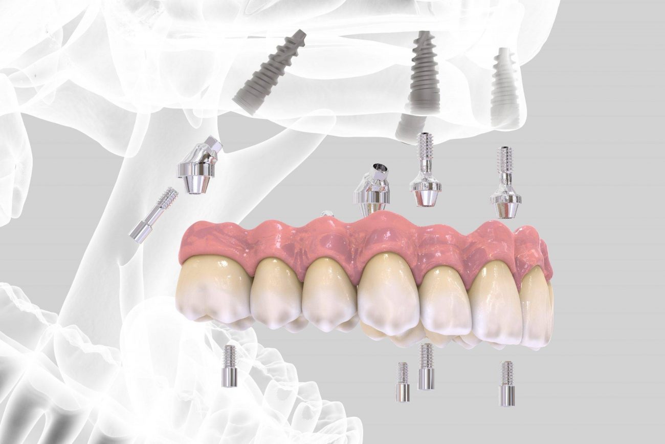 All on 4 Dental Implants | America Dental