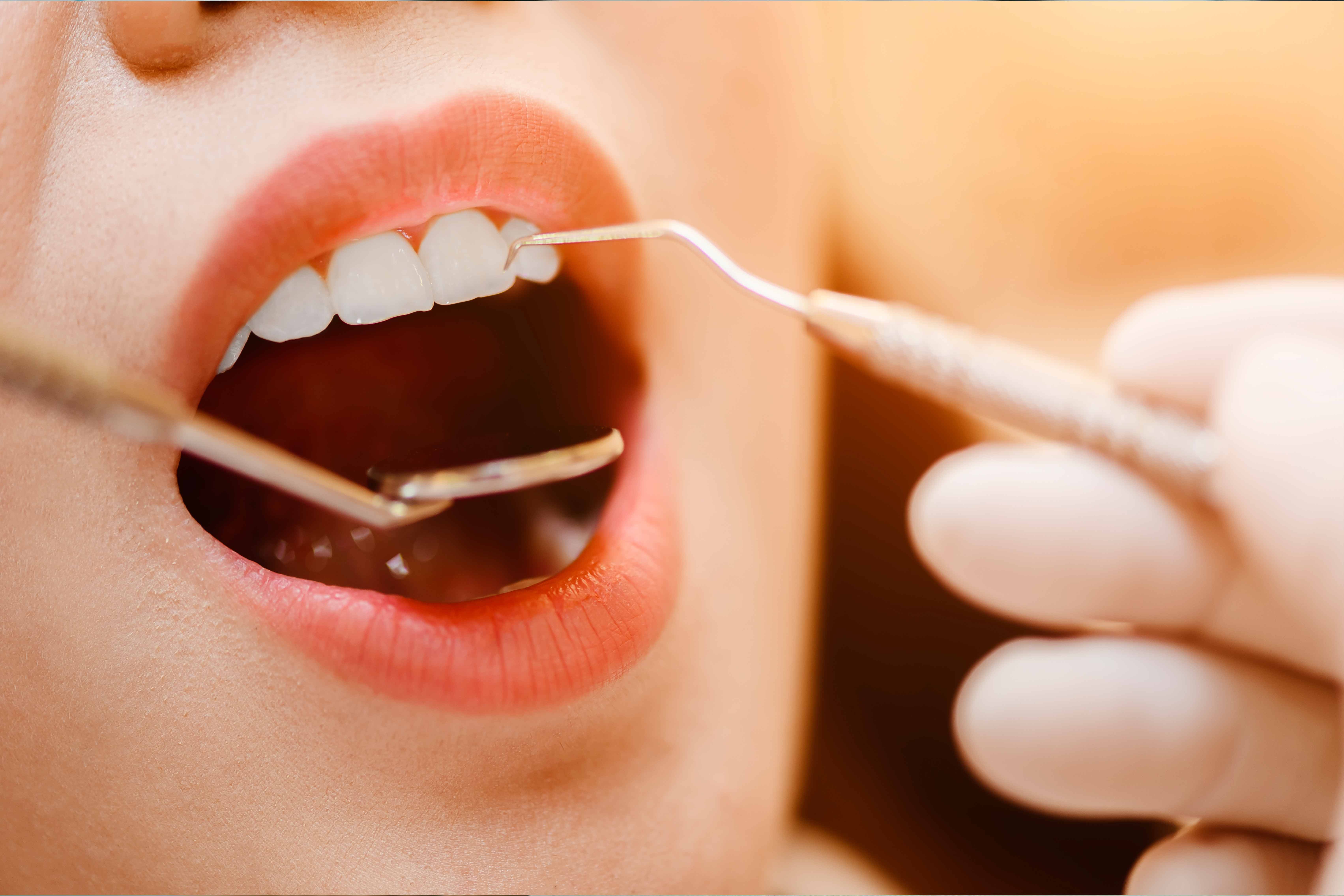 Extraction Process | America Dental