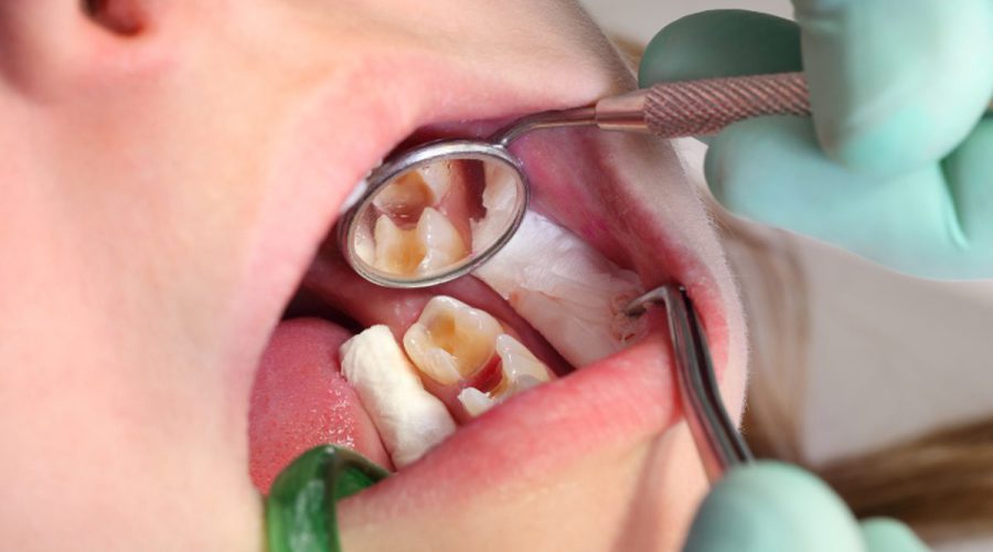 Tooth Decay Prevention Treatment in Costa Rica at America Dental Clinic