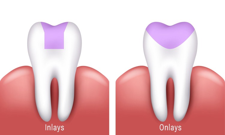 Dental Inlays in Costa Rica at America Dental Clinic